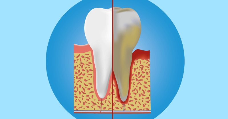 Periodontitis and bacterial inflammation of the tooth socket | Bioniq